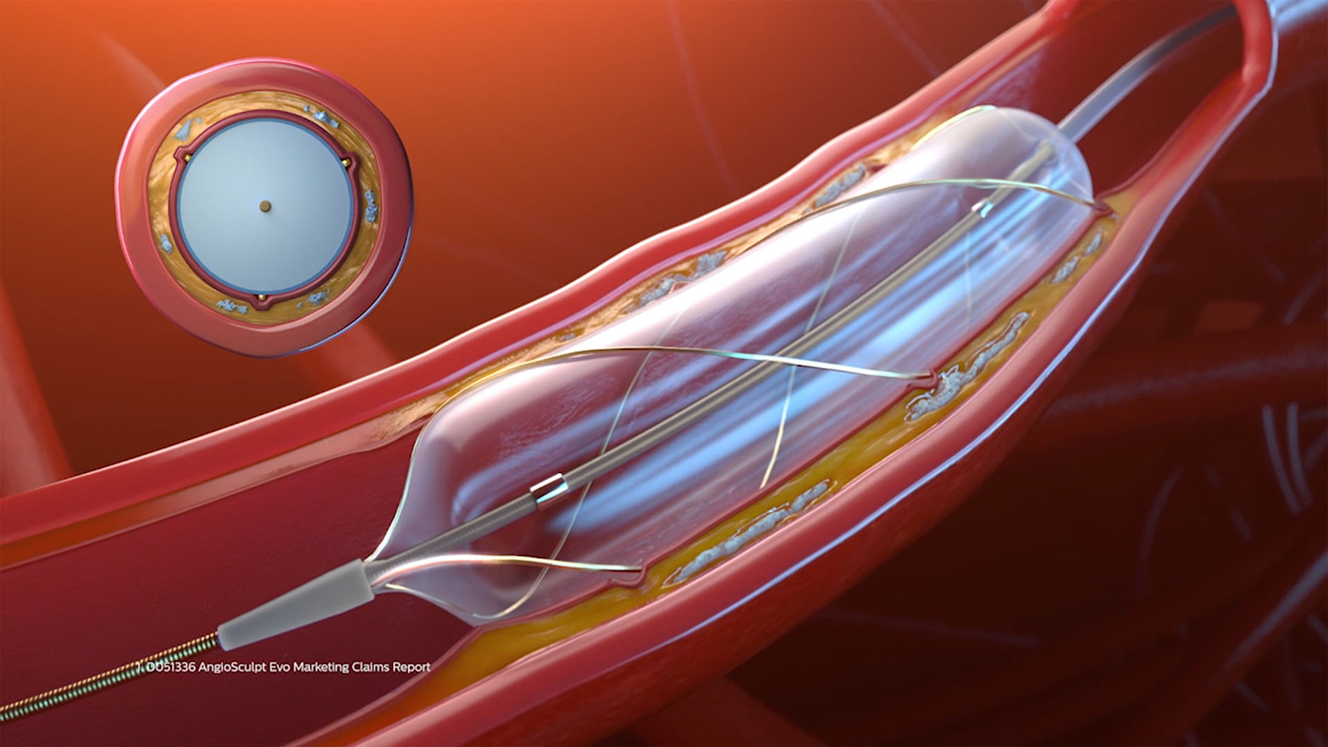 Spectranetics | Philips